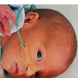 Intestinal Atresia – The Baby Specialist